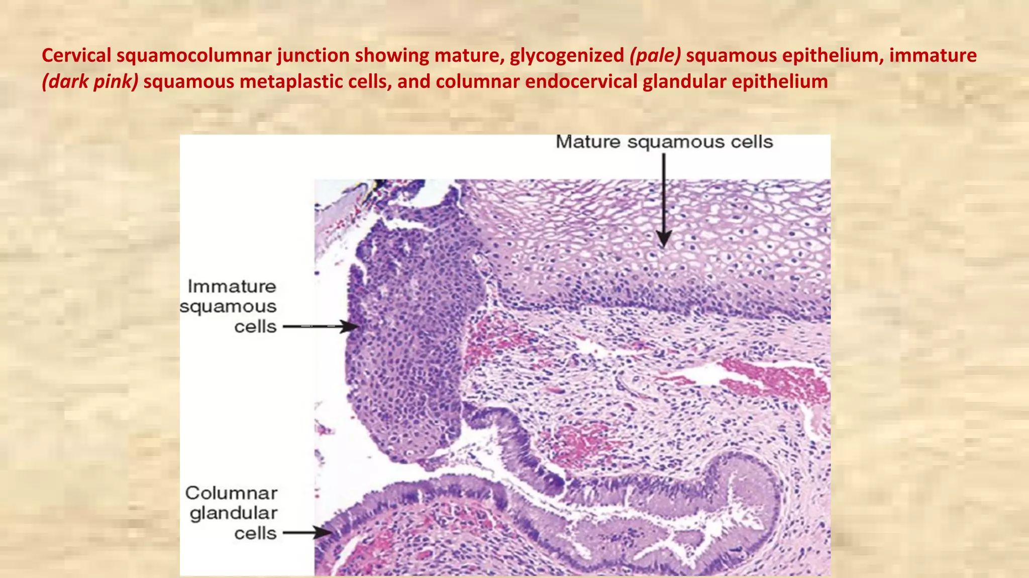 Lecture 1 Pathology: Cervix pdf | PDF