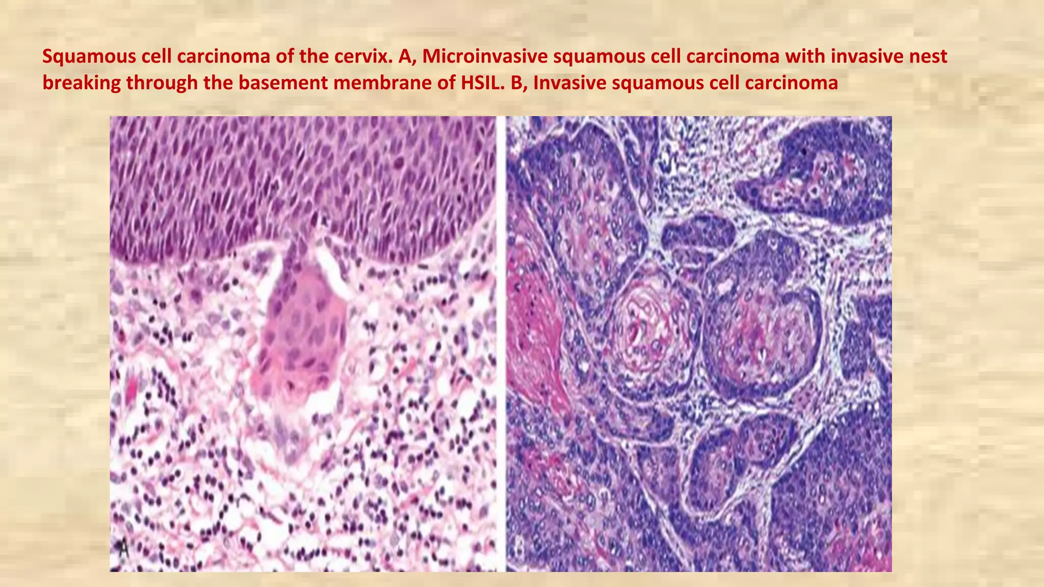 Lecture 1 Pathology: Cervix pdf | PDF