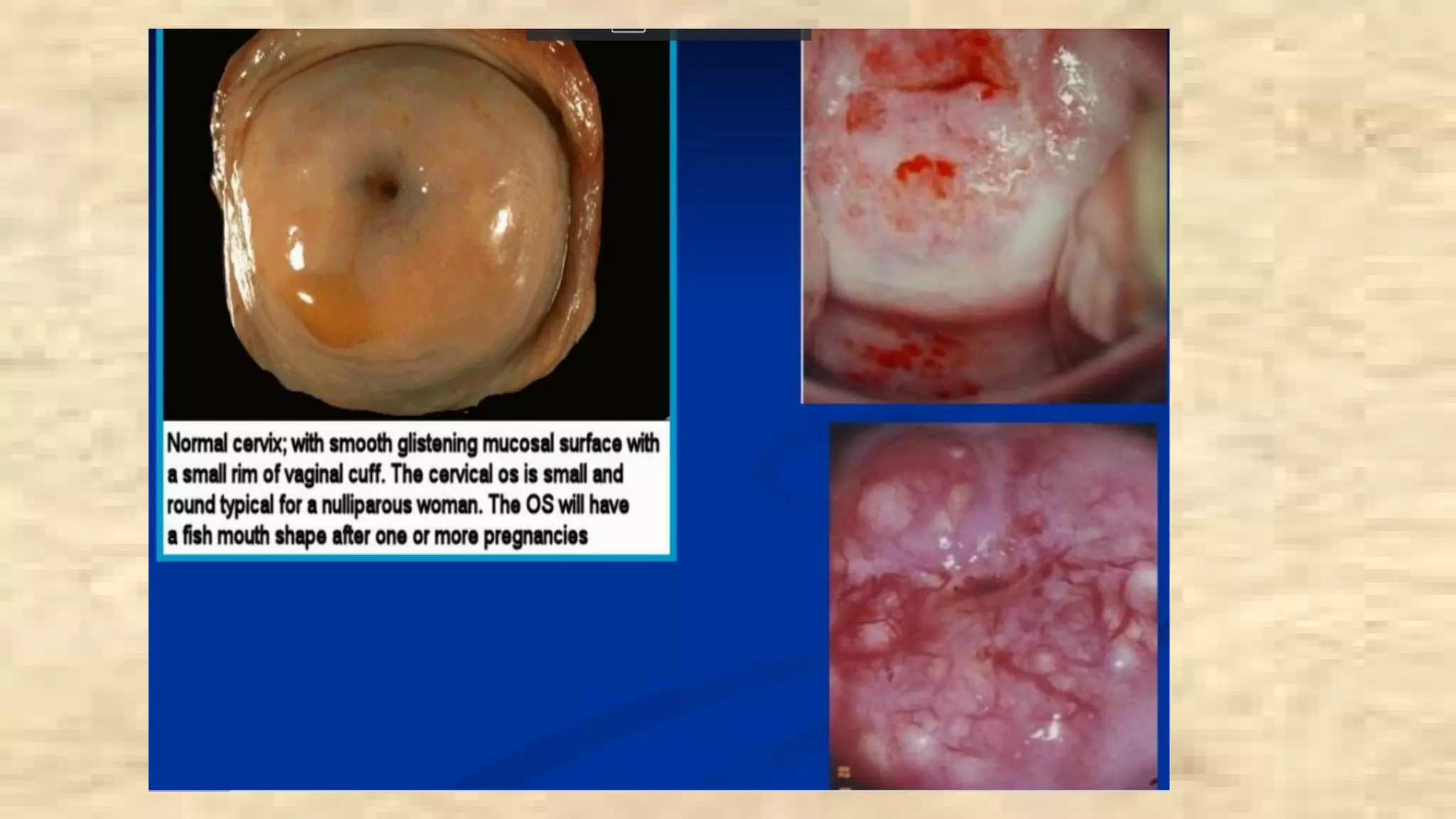 Lecture 1 Pathology Cervix Pdf Pdf