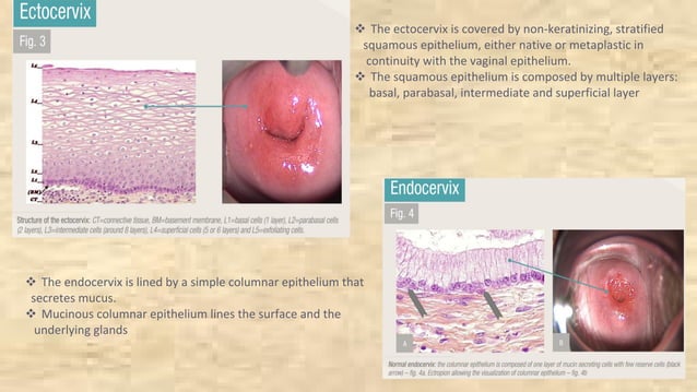 Lecture 1 Pathology: Cervix pdf | PDF | Cancer | Diseases and Conditions