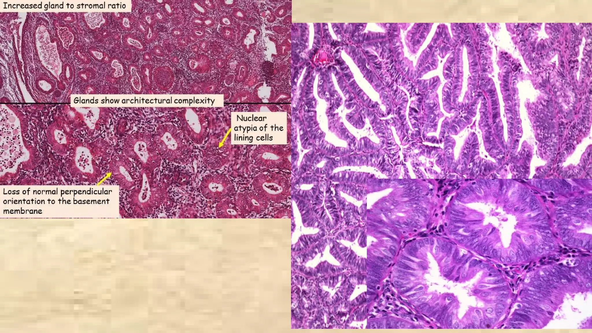 Lecture 2 Pathology: Uterus pdf | PPT