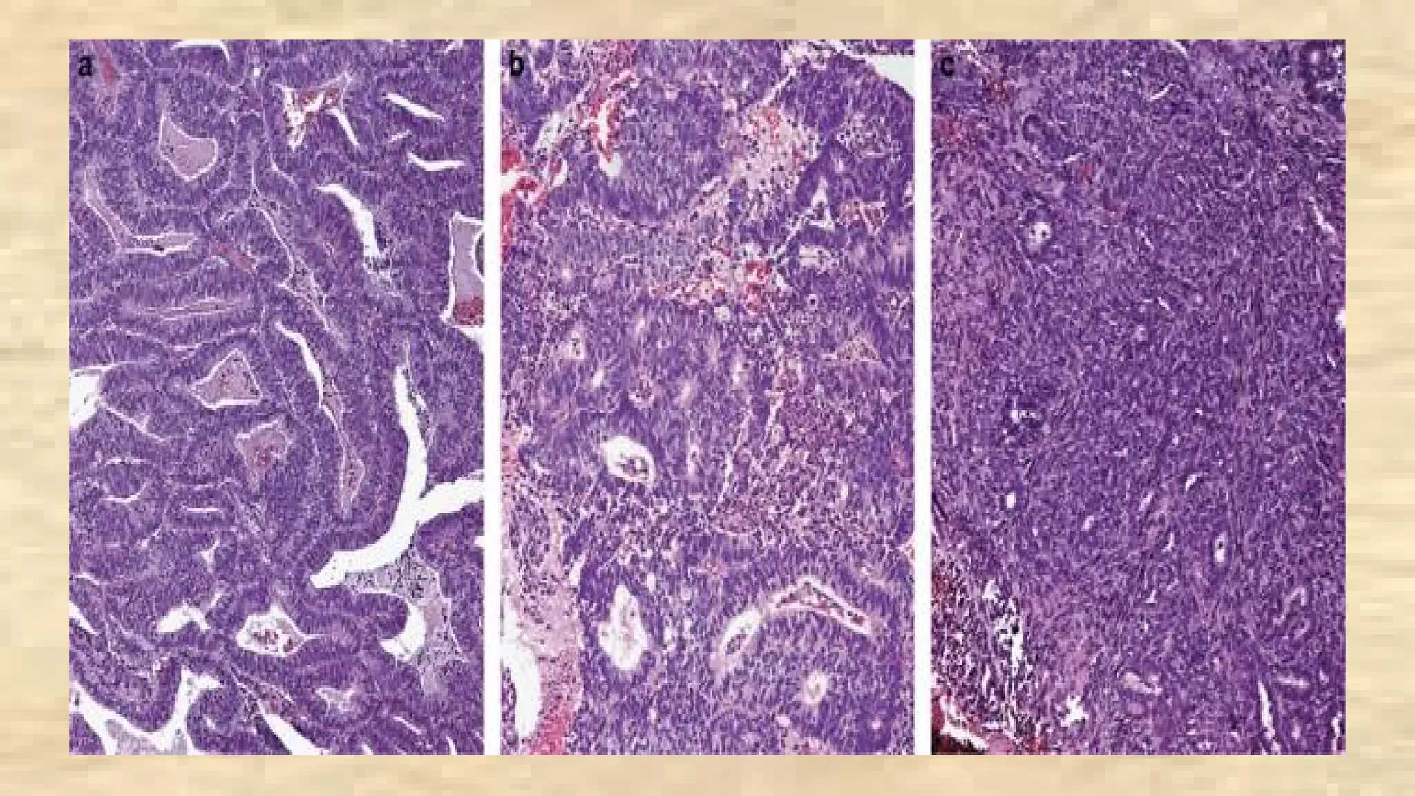 Lecture 2 Pathology: Uterus pdf | PPT