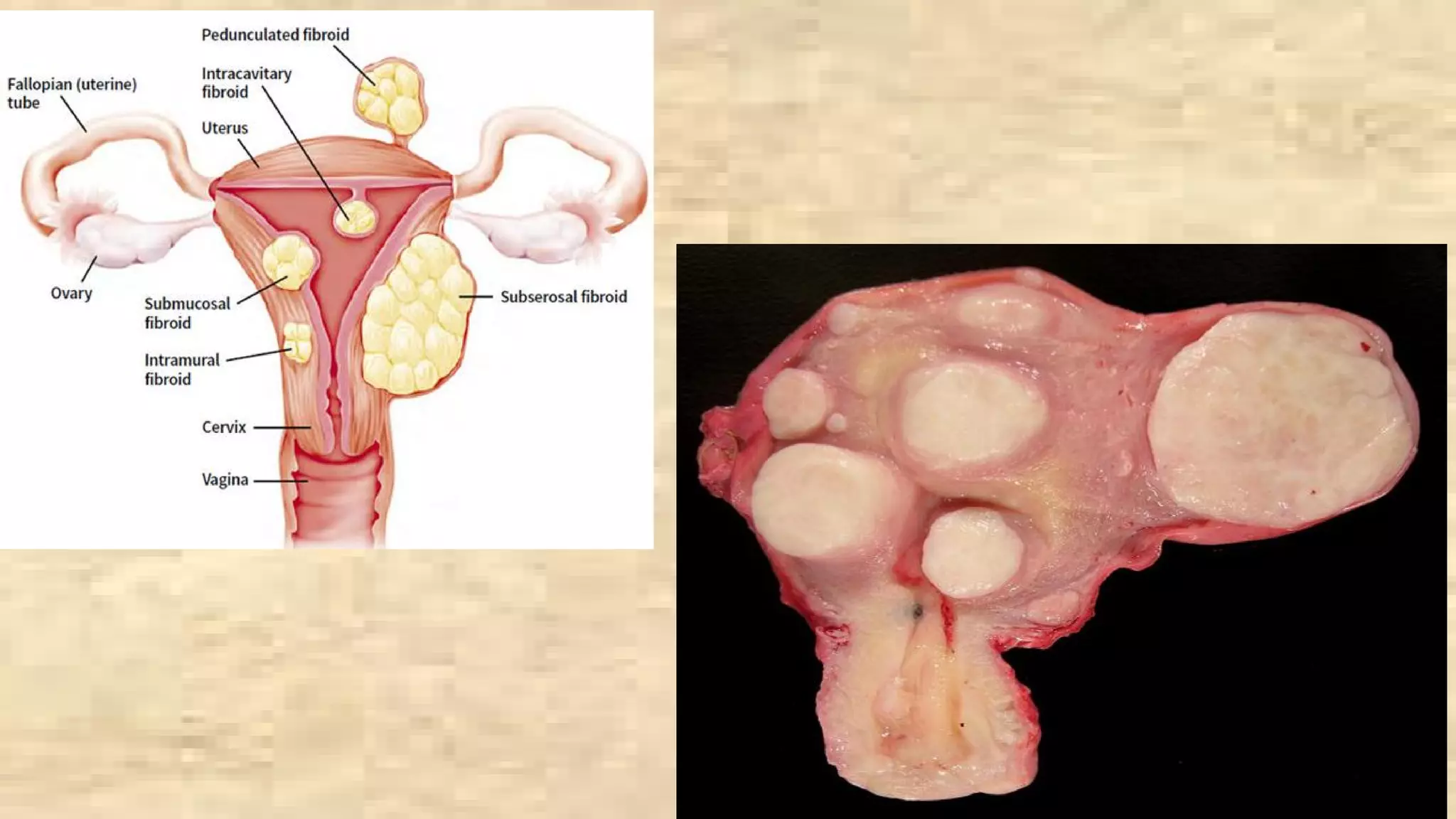 Lecture 2 Pathology: Uterus pdf | PPT