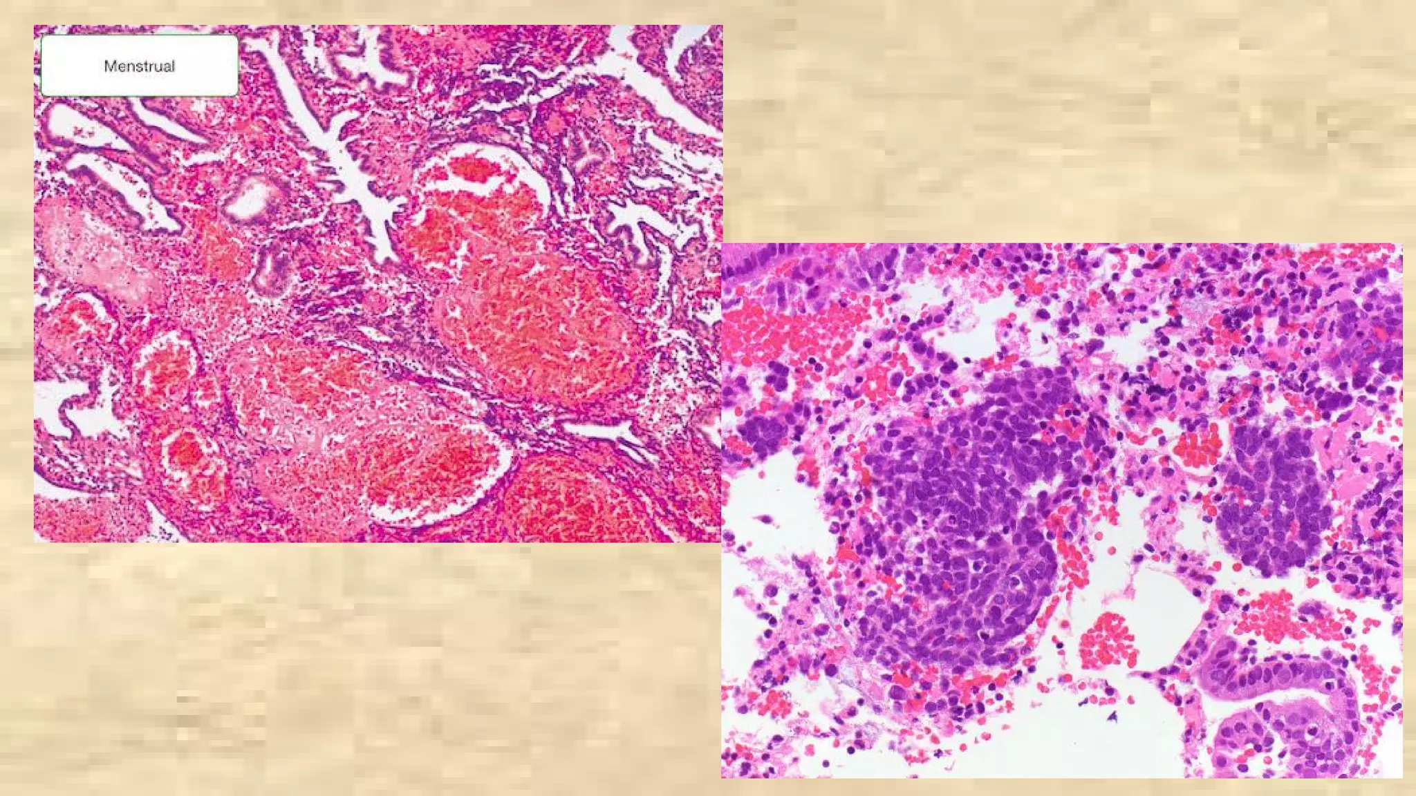 Lecture 2 Pathology: Uterus pdf | PPT