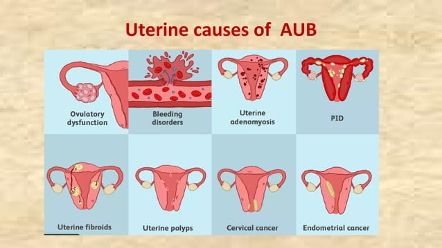 Lecture 2 Pathology: Uterus pdf | PPT