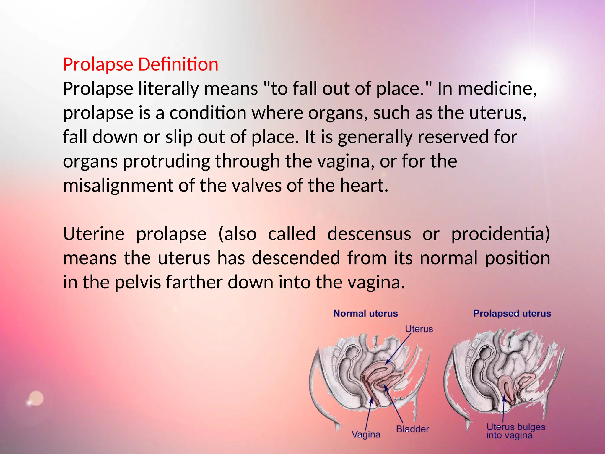 Uterine prolapse presentation for education | PPT