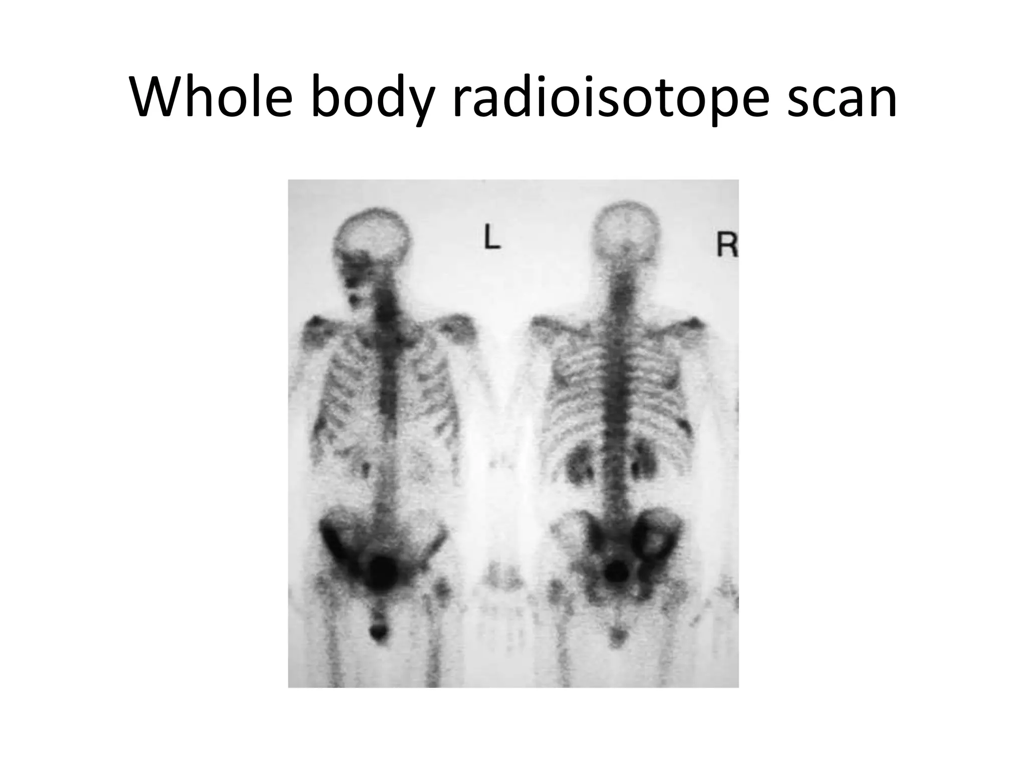 Lecture Thyroid Malignancies Pptx Thyroid Disorders Endocrine And Metabolic Diseases
