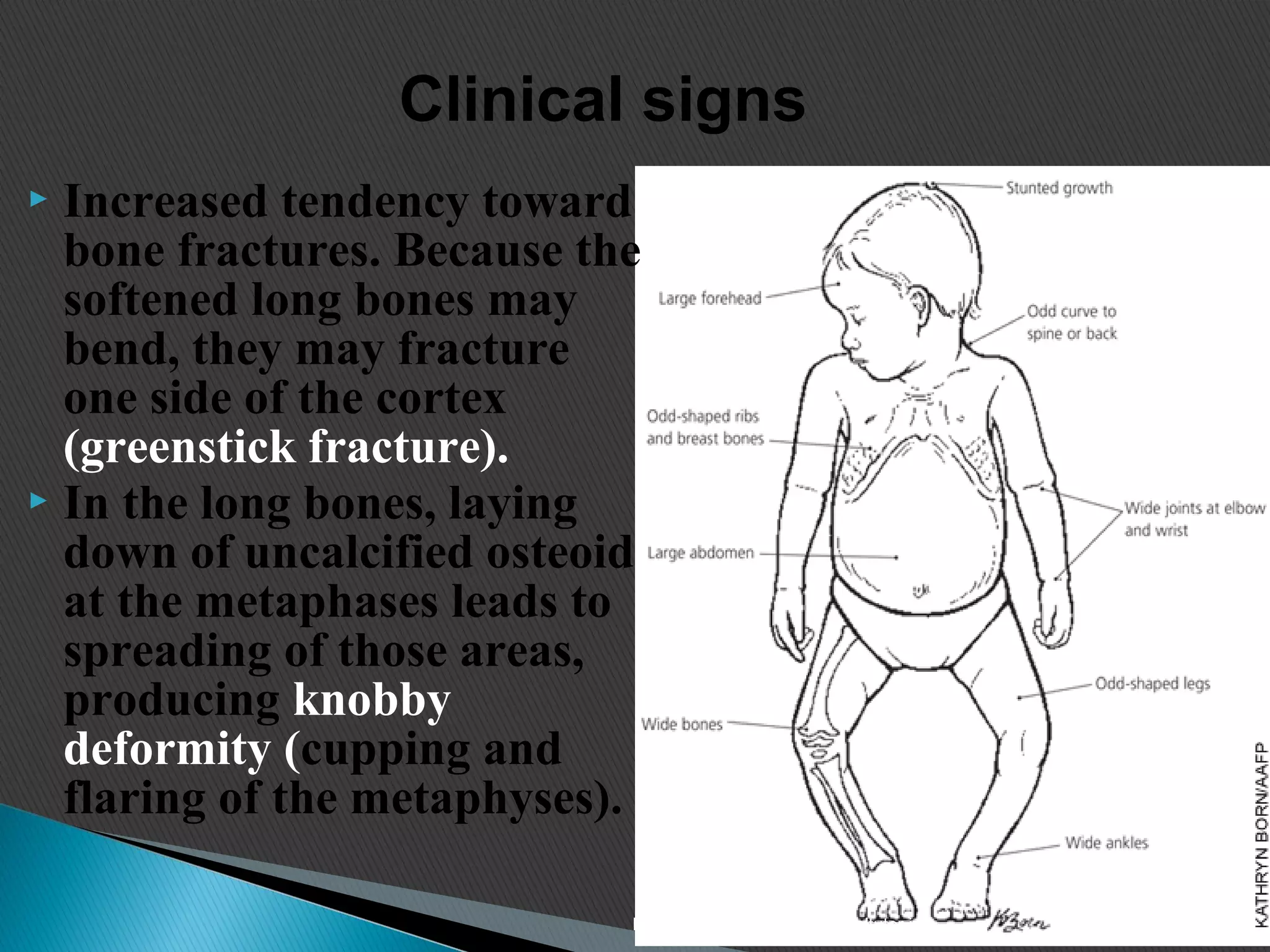 Lecture rickets | PPT