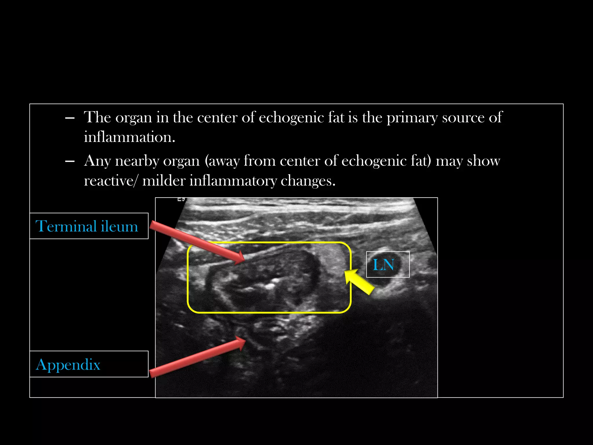 Emergency Ultrasound Course -Lecture 02 -Urgent sonographic signs -Part ...