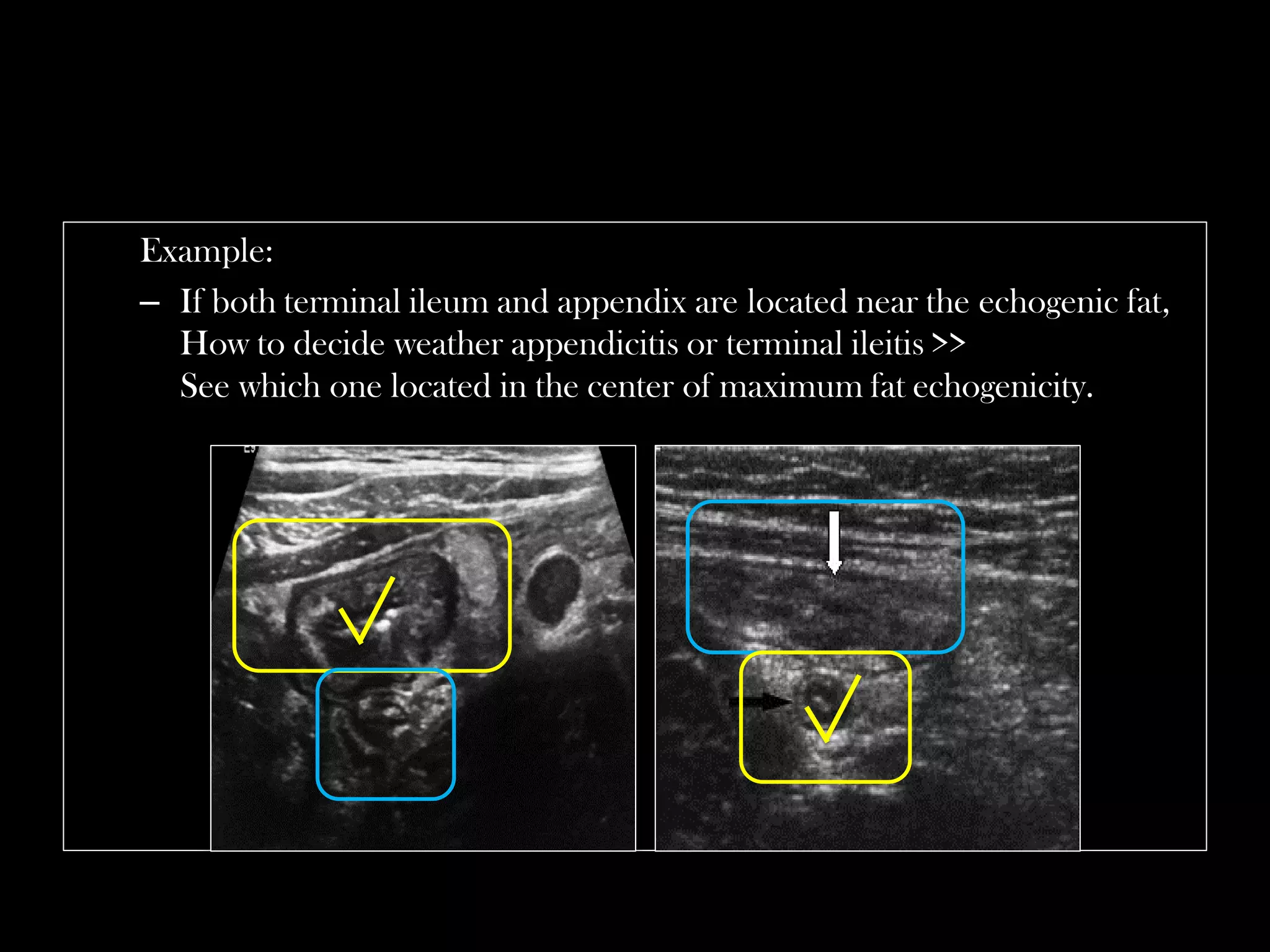 Emergency Ultrasound Course -Lecture 02 -Urgent sonographic signs -Part ...