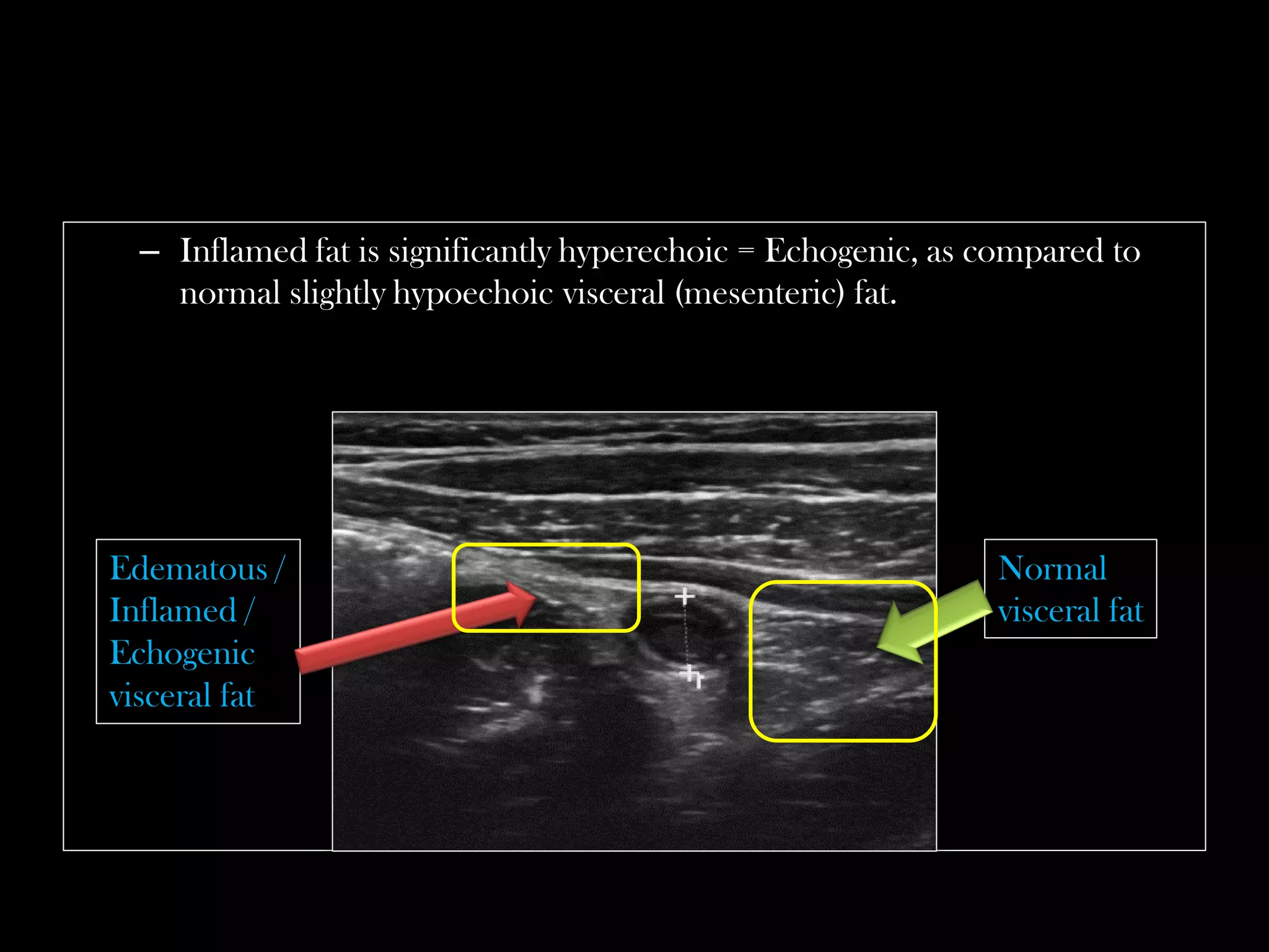 Emergency Ultrasound Course -Lecture 02 -Urgent sonographic signs -Part ...