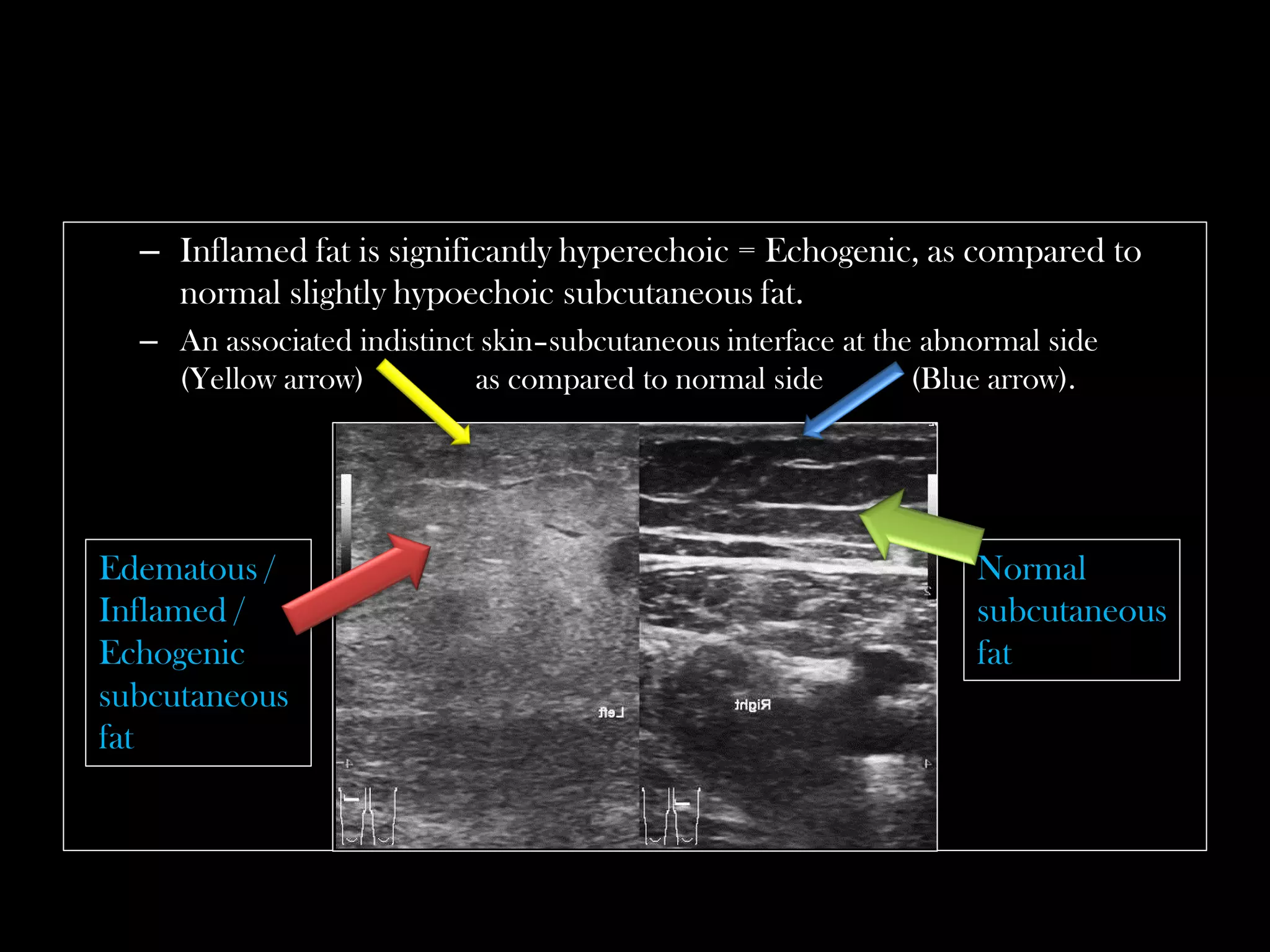 Emergency Ultrasound Course -Lecture 02 -Urgent sonographic signs -Part ...