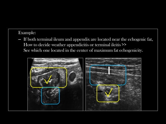 Emergency Ultrasound Course -Lecture 02 -Urgent sonographic signs -Part ...