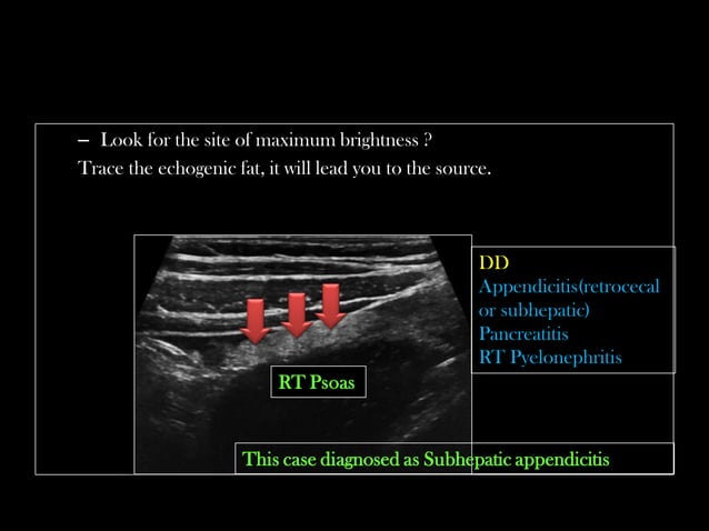 Emergency Ultrasound Course -Lecture 02 -Urgent sonographic signs -Part ...