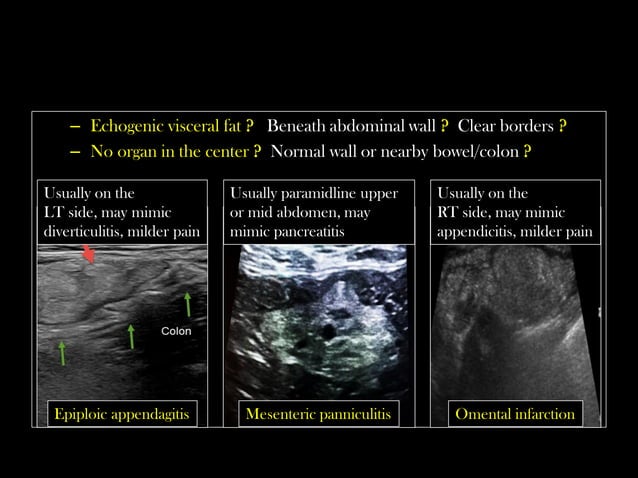 Emergency Ultrasound Course -Lecture 02 -Urgent sonographic signs -Part ...