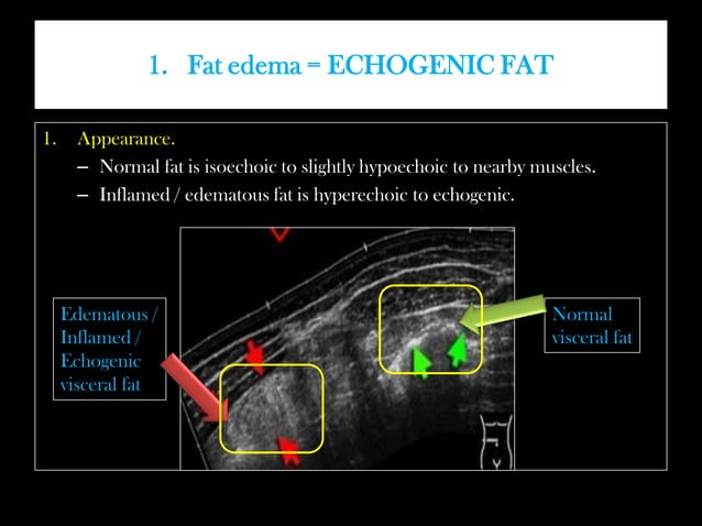 Emergency Ultrasound Course -Lecture 02 -Urgent sonographic signs -Part ...