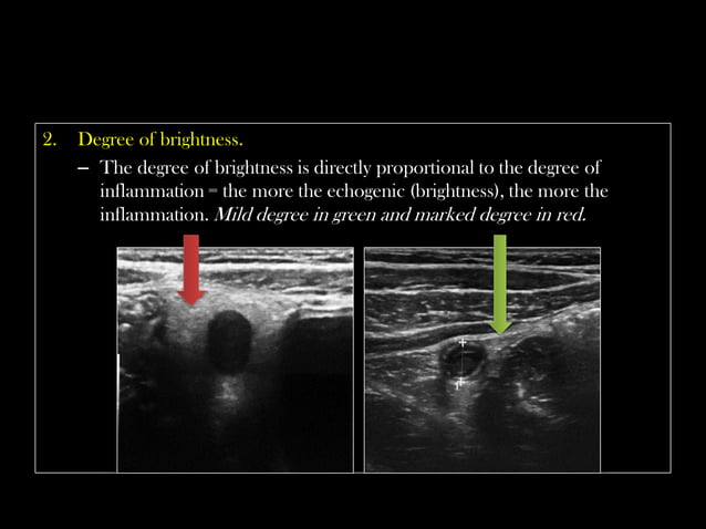 Emergency Ultrasound Course -Lecture 02 -Urgent sonographic signs -Part ...