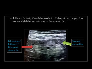 Hyperechoic Ultrasound