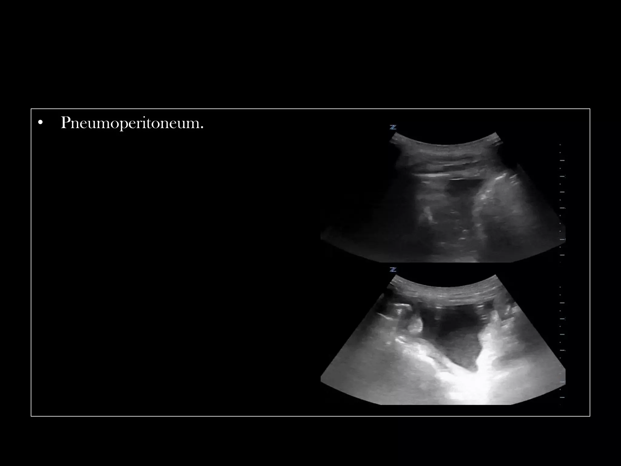 Emergency Ultrasound Course -Lecture 02 -Urgent sonographic signs -Part ...