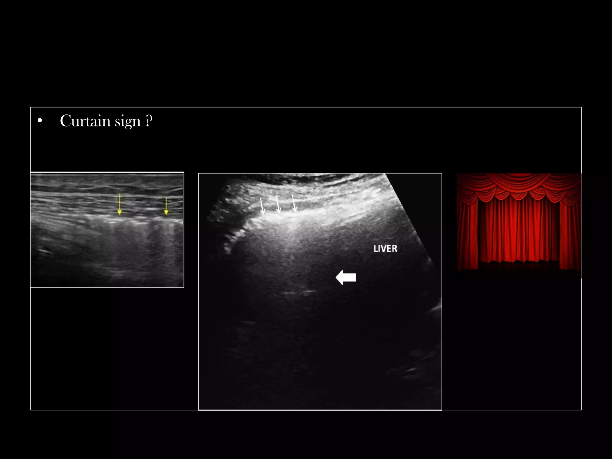 Emergency Ultrasound Course -Lecture 02 -Urgent sonographic signs -Part ...