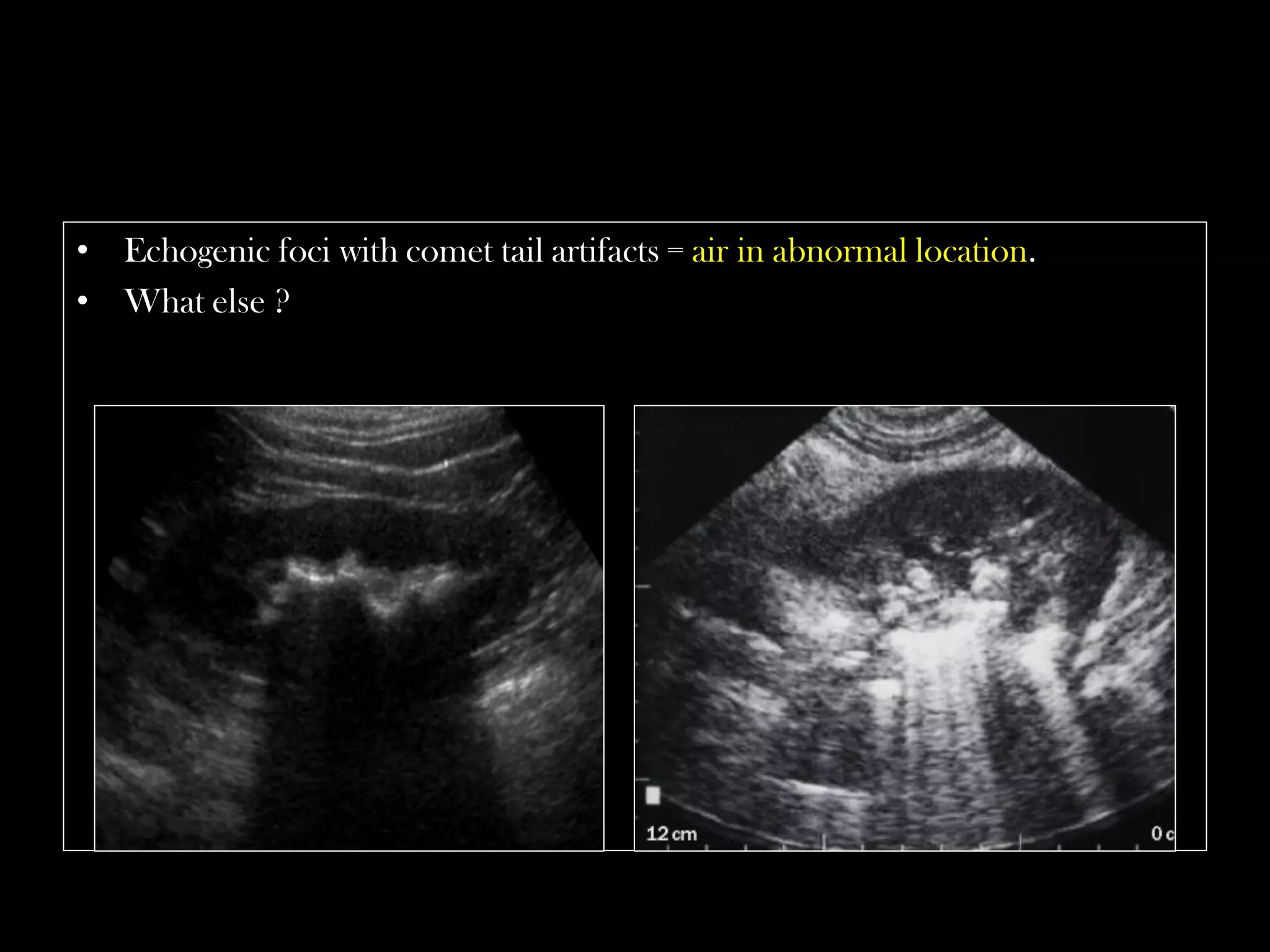 Emergency Ultrasound Course -Lecture 02 -Urgent sonographic signs -Part ...