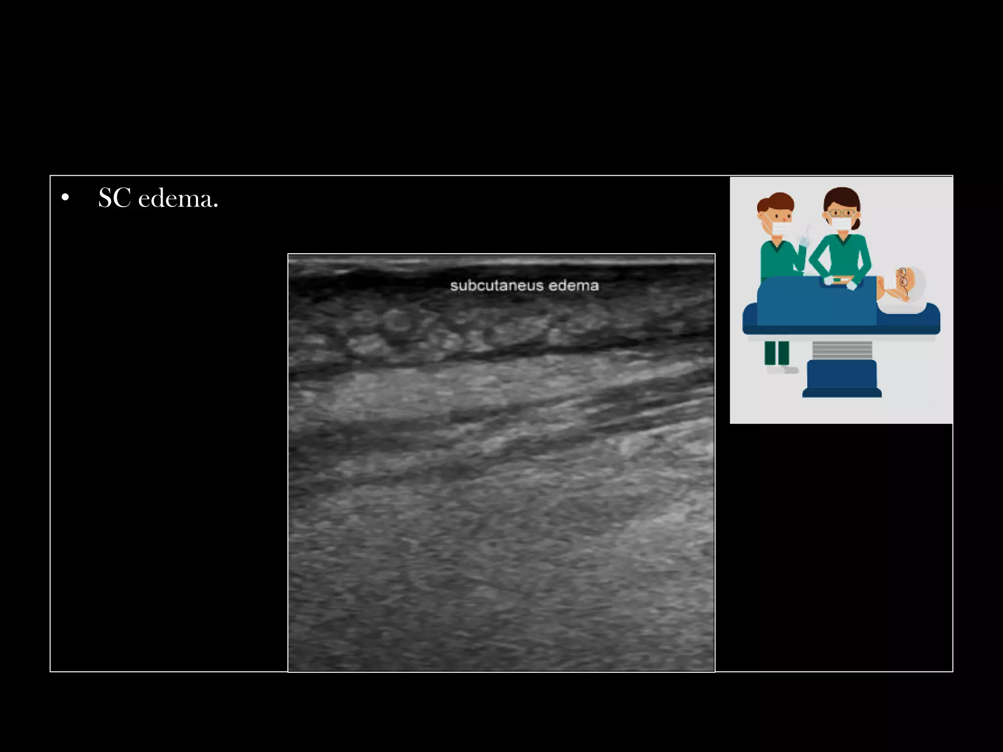 Emergency Ultrasound Course -Lecture 02 -Urgent sonographic signs -Part ...