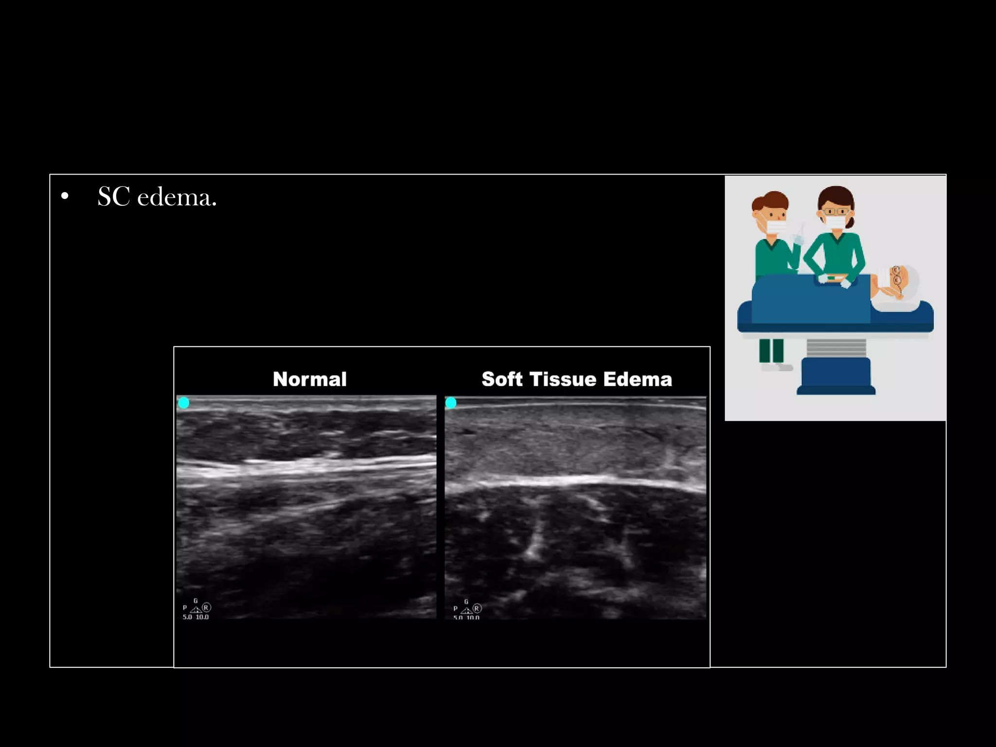 Emergency Ultrasound Course -Lecture 02 -Urgent sonographic signs -Part ...