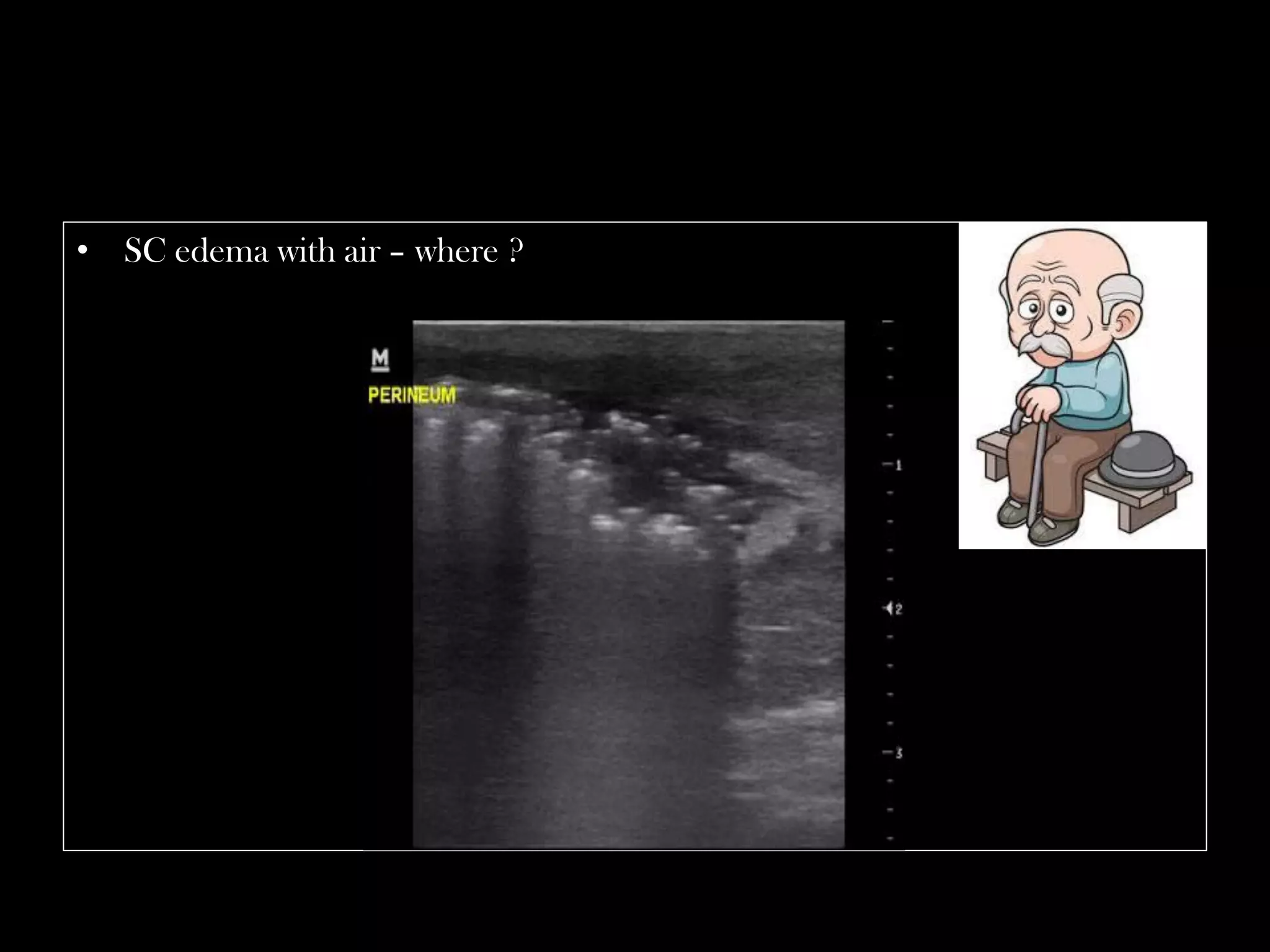Emergency Ultrasound Course -Lecture 02 -Urgent sonographic signs -Part ...