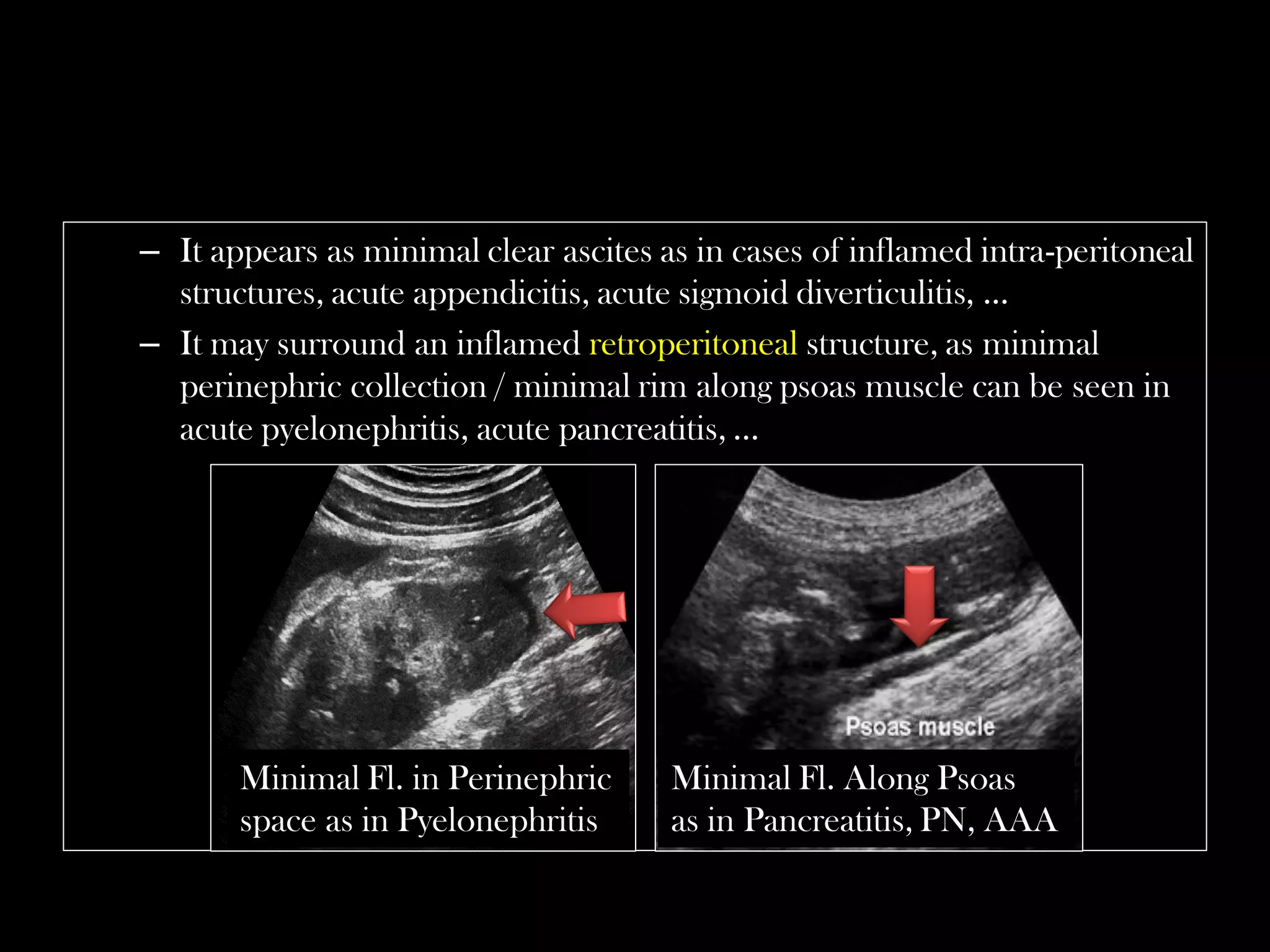 Emergency Ultrasound Course -Lecture 02 -Urgent sonographic signs -Part ...