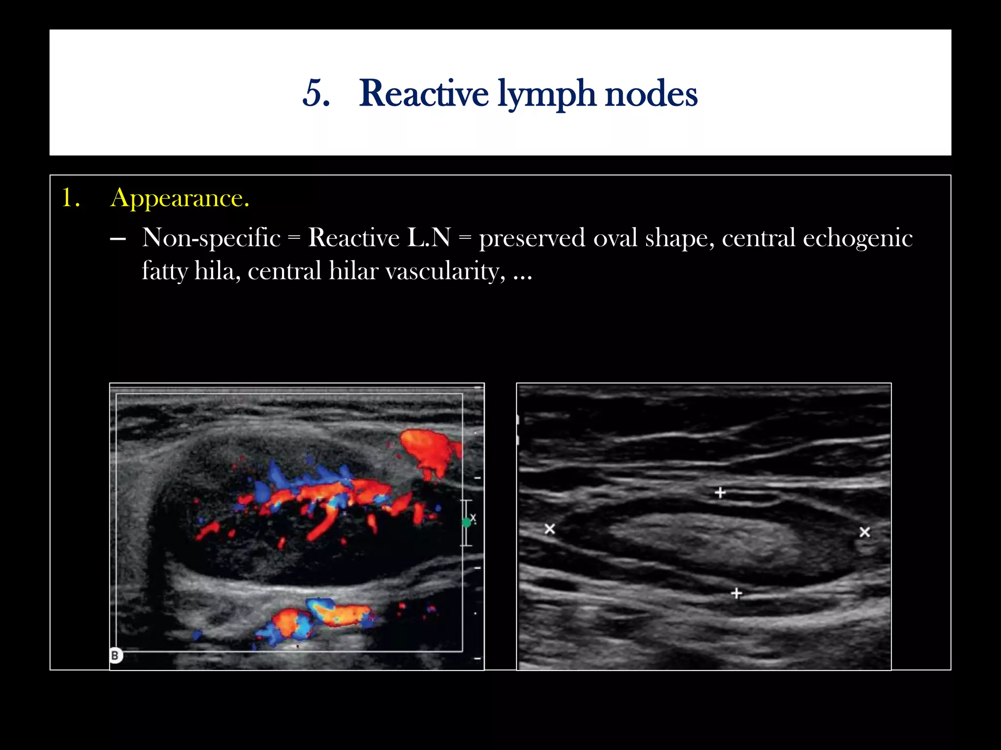 Emergency Ultrasound Course -Lecture 02 -Urgent sonographic signs -Part ...
