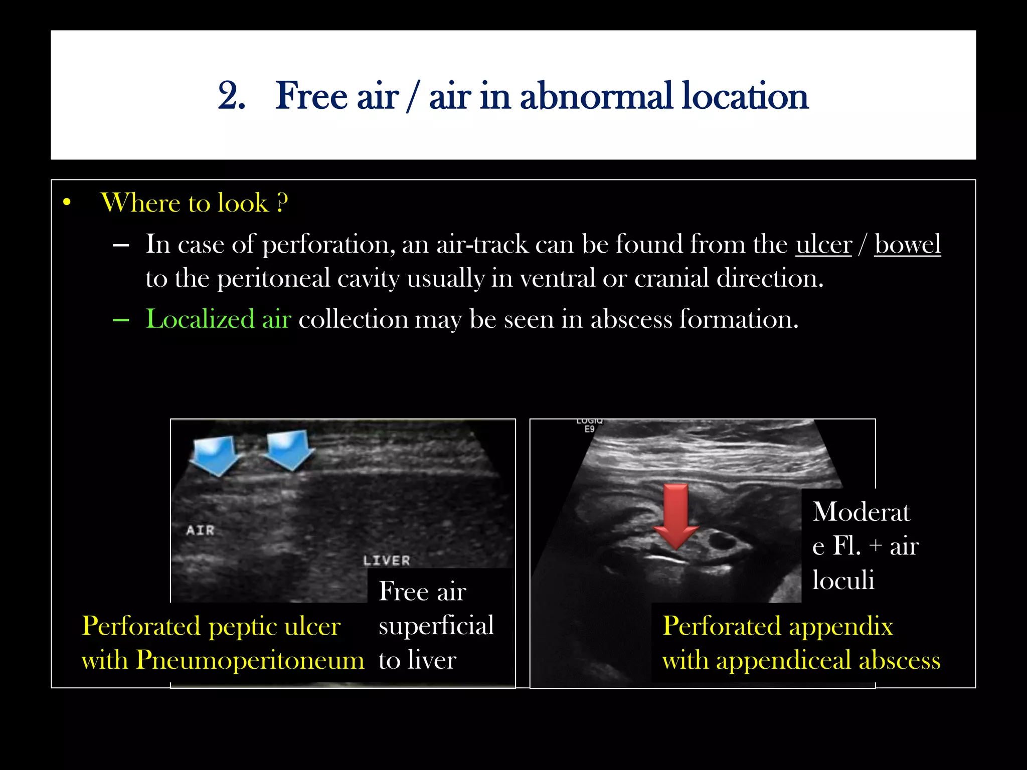 Emergency Ultrasound Course -Lecture 02 -Urgent sonographic signs -Part ...