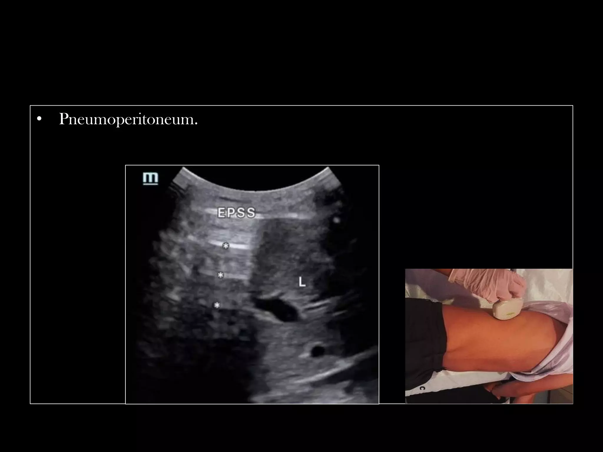 Emergency Ultrasound Course -Lecture 02 -Urgent sonographic signs -Part ...