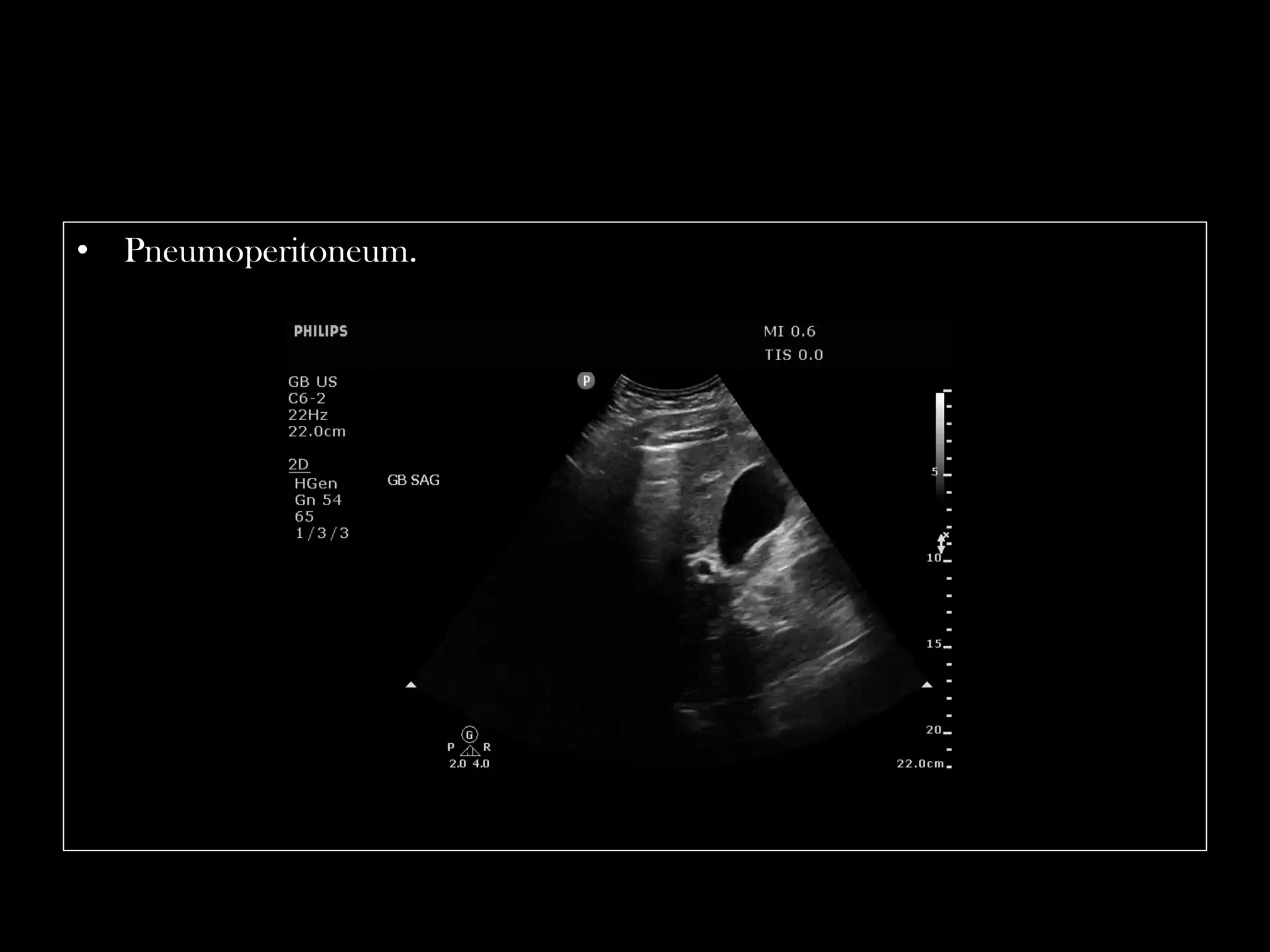 Emergency Ultrasound Course -Lecture 02 -Urgent sonographic signs -Part ...