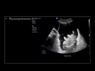 Emergency Ultrasound Course -Lecture 02 -Urgent sonographic signs -Part ...