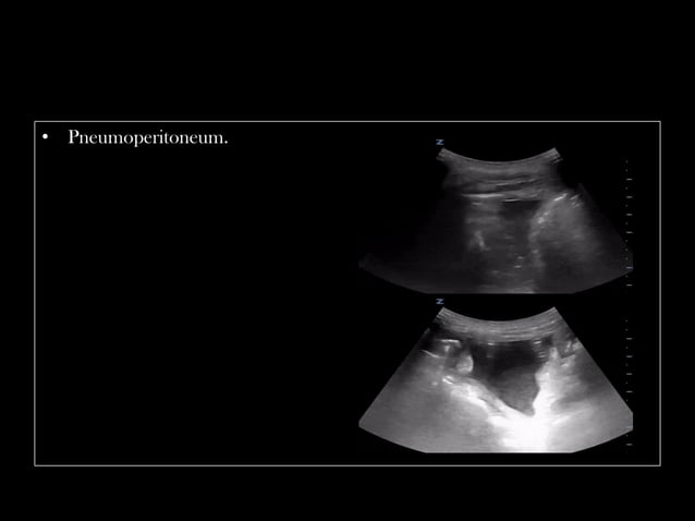 Emergency Ultrasound Course -Lecture 02 -Urgent sonographic signs -Part ...