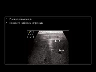 Emergency Ultrasound Course -Lecture 02 -Urgent sonographic signs -Part ...