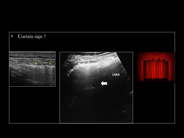 Emergency Ultrasound Course -Lecture 02 -Urgent sonographic signs -Part ...