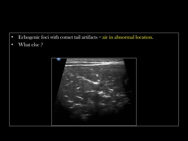 Emergency Ultrasound Course -Lecture 02 -Urgent sonographic signs -Part ...