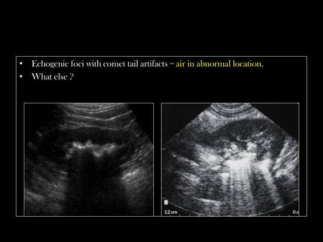 Emergency Ultrasound Course -Lecture 02 -Urgent sonographic signs -Part ...