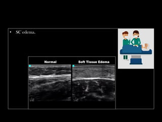 Emergency Ultrasound Course -Lecture 02 -Urgent sonographic signs -Part ...