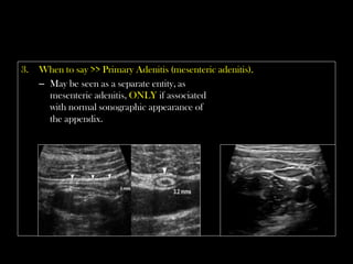 Emergency Ultrasound Course -Lecture 02 -Urgent sonographic signs -Part ...