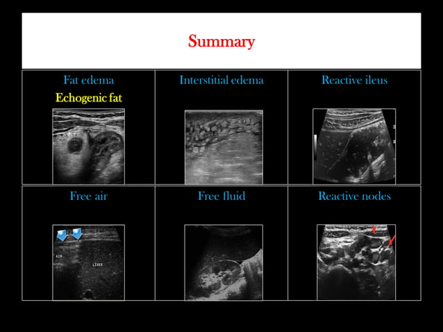 Emergency Ultrasound Course -Lecture 02 -Urgent sonographic signs -Part ...