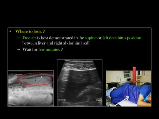 Emergency Ultrasound Course -Lecture 02 -Urgent sonographic signs -Part ...