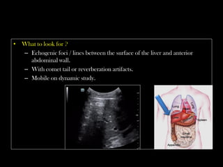 Emergency Ultrasound Course -Lecture 02 -Urgent sonographic signs -Part ...