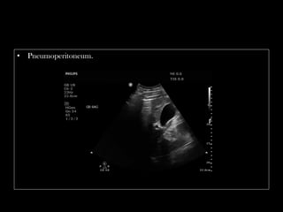 Emergency Ultrasound Course -Lecture 02 -Urgent sonographic signs -Part ...