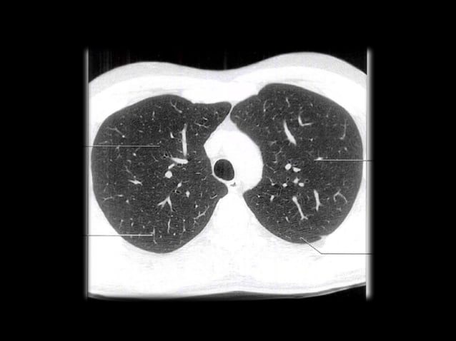 Radiological anatomy of the Chest. .pptx
