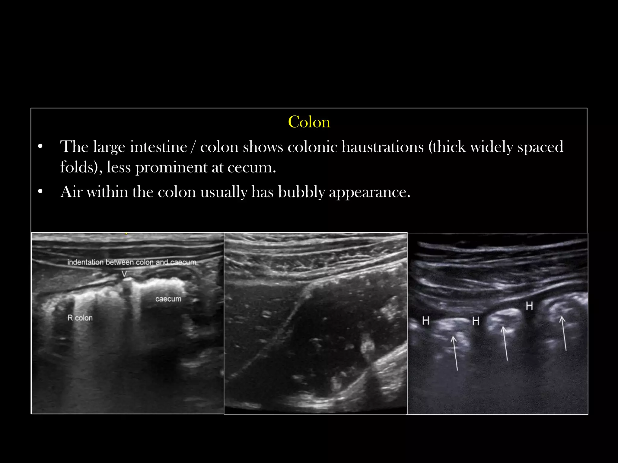 Emergency Ultrasound Course -Lecture 03 -Introduction to bowel ...