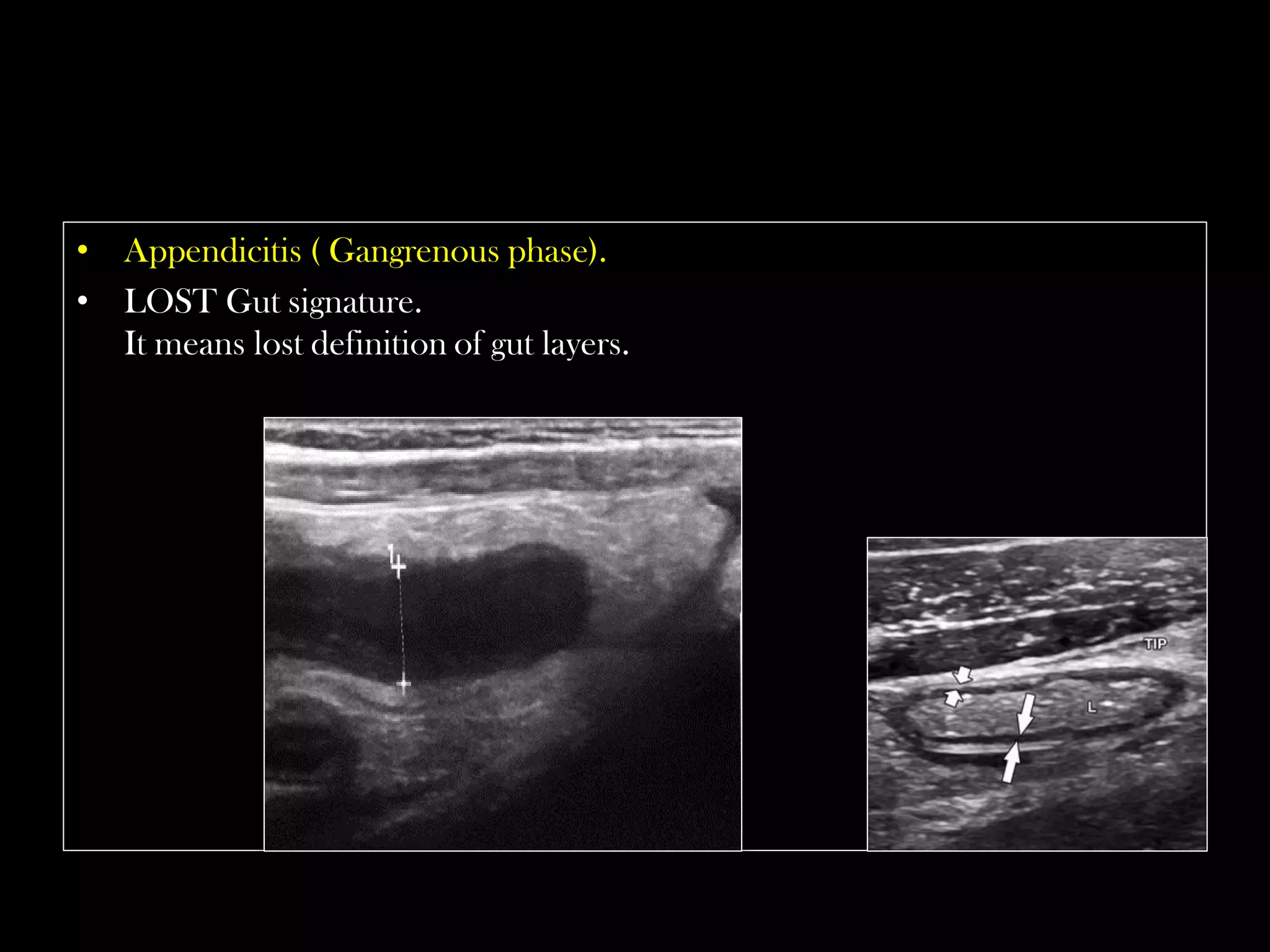 Emergency Ultrasound Course -Lecture 03 -Introduction to bowel ...