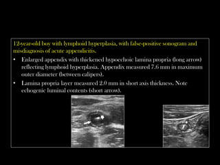 Emergency Ultrasound Course -Lecture 03 -Introduction to bowel ...