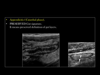 Emergency Ultrasound Course -Lecture 03 -Introduction to bowel ...